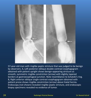 Esophageal Strictures | PDF