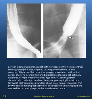 Esophageal Strictures | PDF