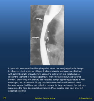 Esophageal Strictures | PDF