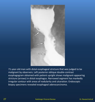Esophageal Strictures | PDF
