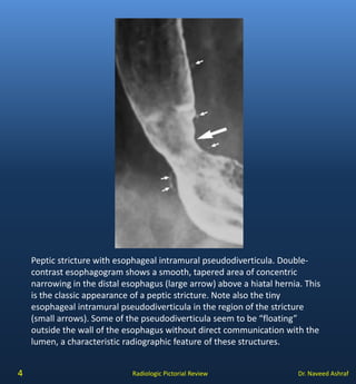 Esophageal Strictures | PDF