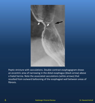 Esophageal Strictures | PDF