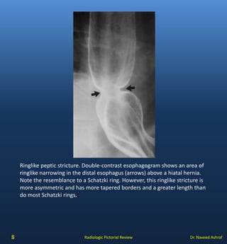 Esophageal Strictures | PDF