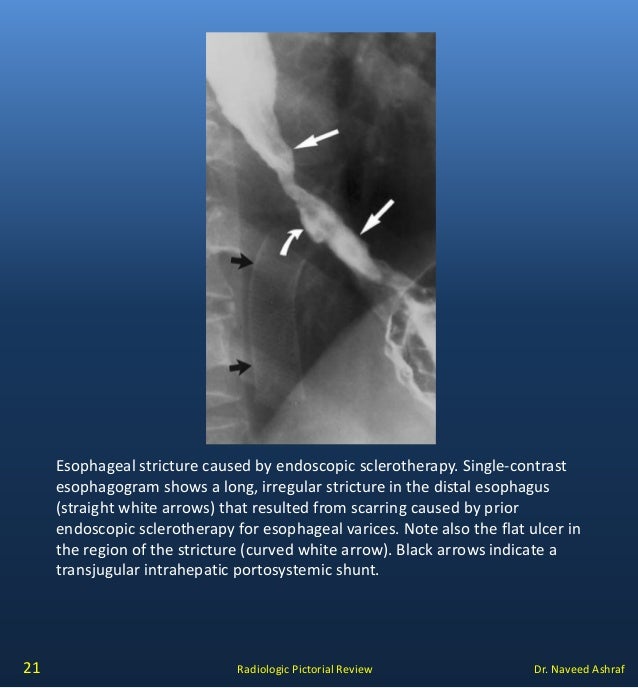 Esophageal Strictures