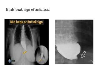 Anesthesia for esophageal Esophageal Surgery.pptx