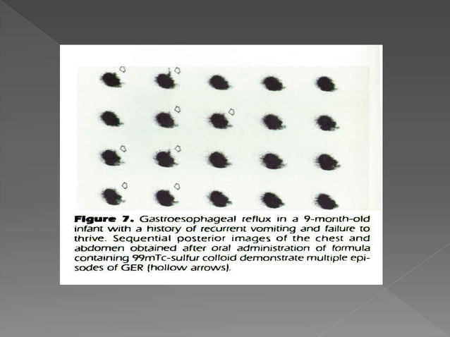 Esophageal transit imaging | PPTX | Digestive Disorders | Diseases and ...