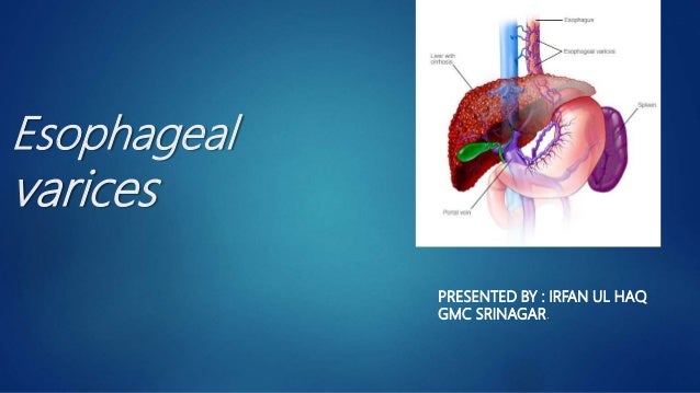 Gastroesophageal Varices