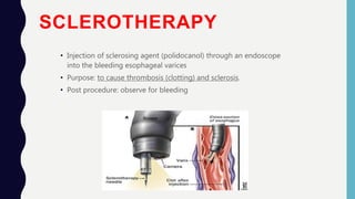 Esophageal varices | PPSX