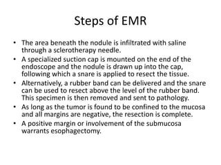 Surgical management of Carcinoma Esophagus | PPTX