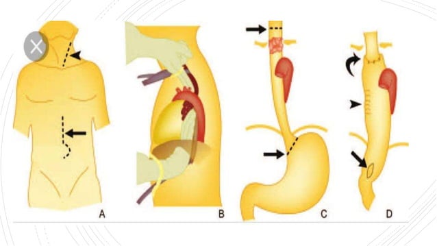 Esophagectomy | PPTX | Digestive Disorders | Diseases and Conditions
