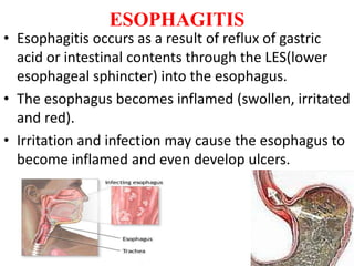 Esophagitis.pptx | Digestive Disorders | Diseases and Conditions