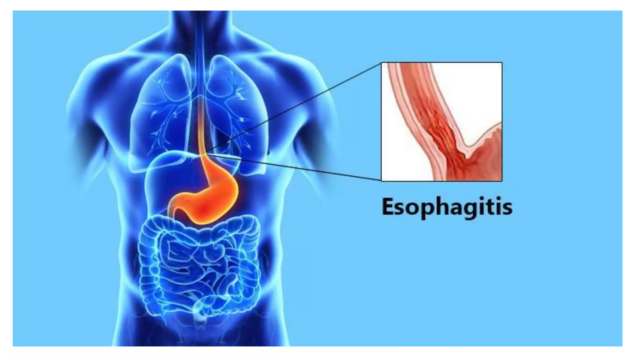 Esophagitis: Symptoms, Causes and Treatment | PPTX