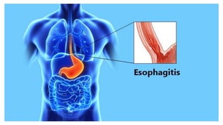 Esophagitis: Symptoms, Causes and Treatment | PPT