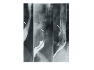 Esophageal Varices X Ray