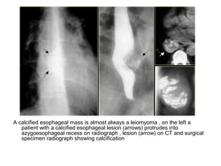 Esophagus Cancer Xray