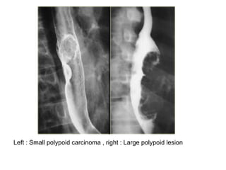 Esophageal Cancer X Ray