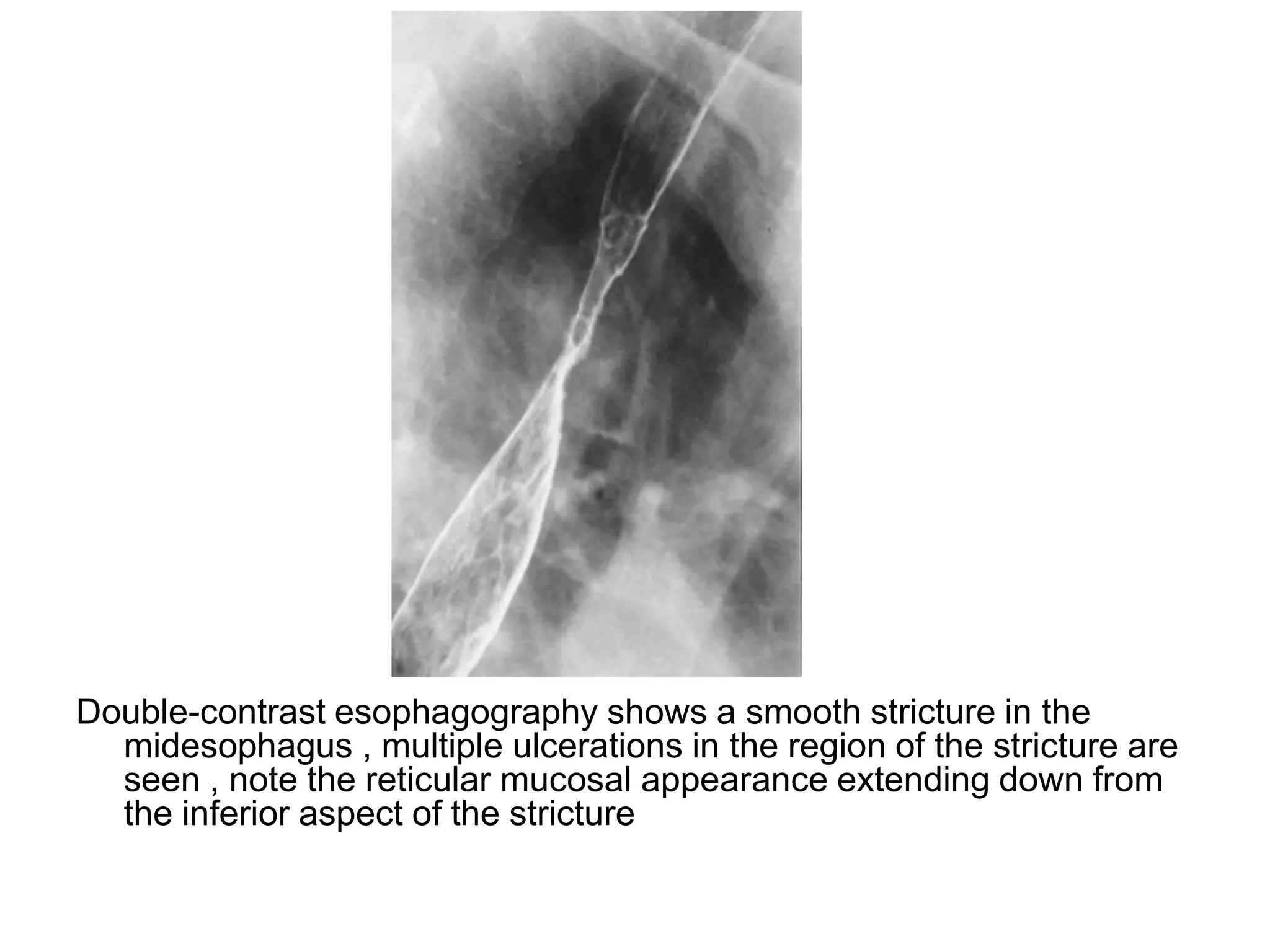 esophagus.pptx