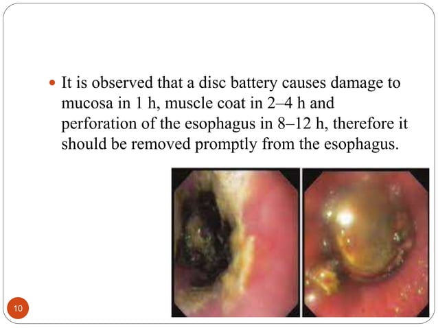 Esophagus foreign bodies | PPTX | Ear, Nose and Throat Conditions ...