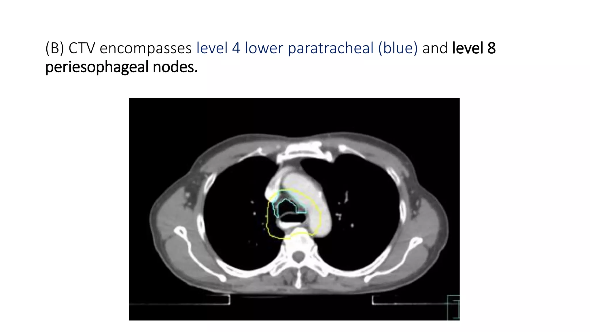 Esophagus Contouring.pptx