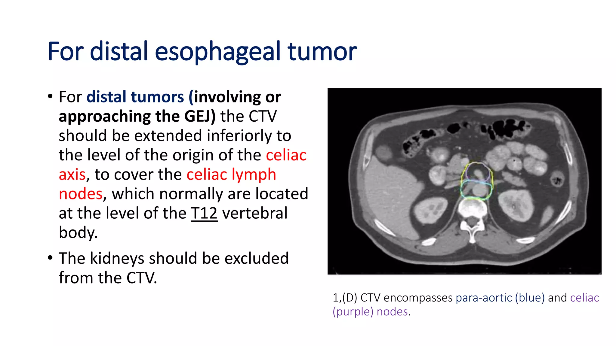 Esophagus Contouring.pptx
