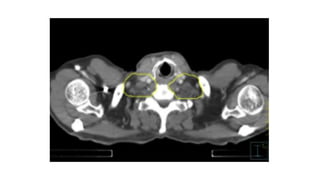 Esophagus Contouring.pptx