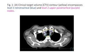 Esophagus Contouring.pptx