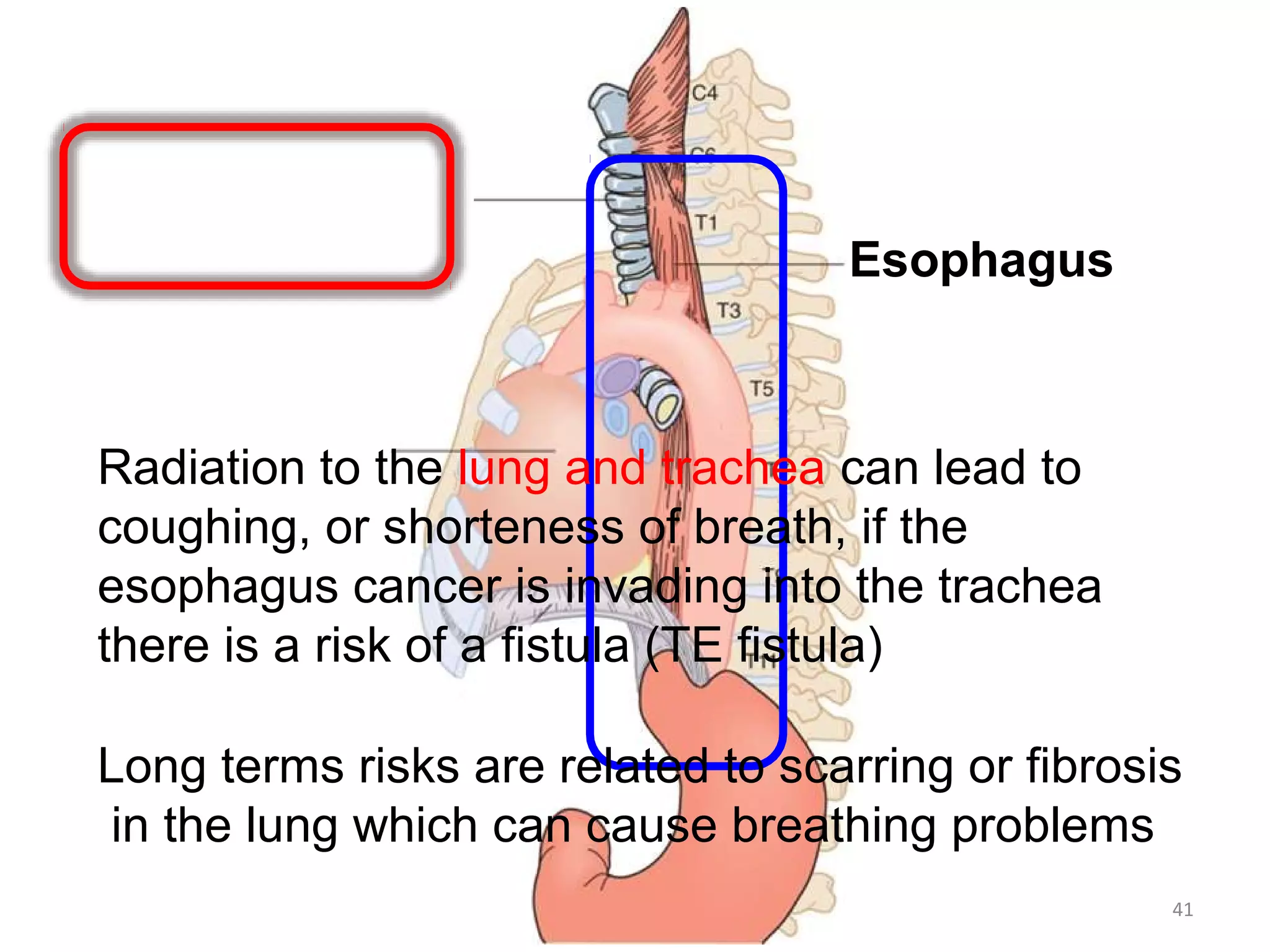 TARGET DELINEATION OF CANCER ESOPHAGUS | PPT