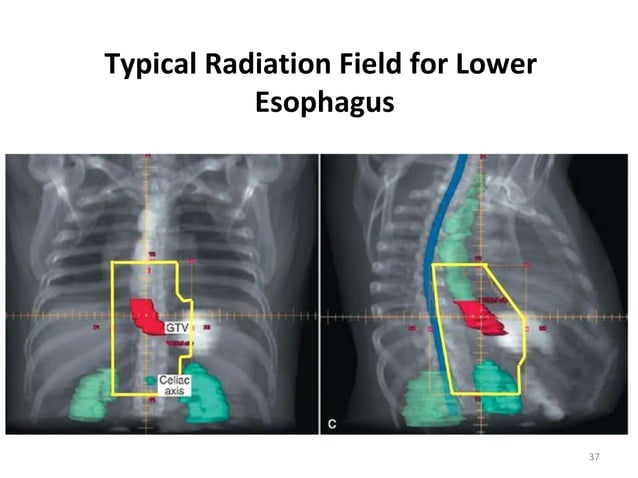 TARGET DELINEATION OF CANCER ESOPHAGUS | PPT