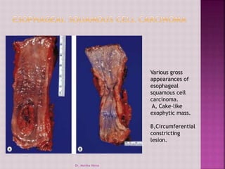 Esophagus Gross Anatomy