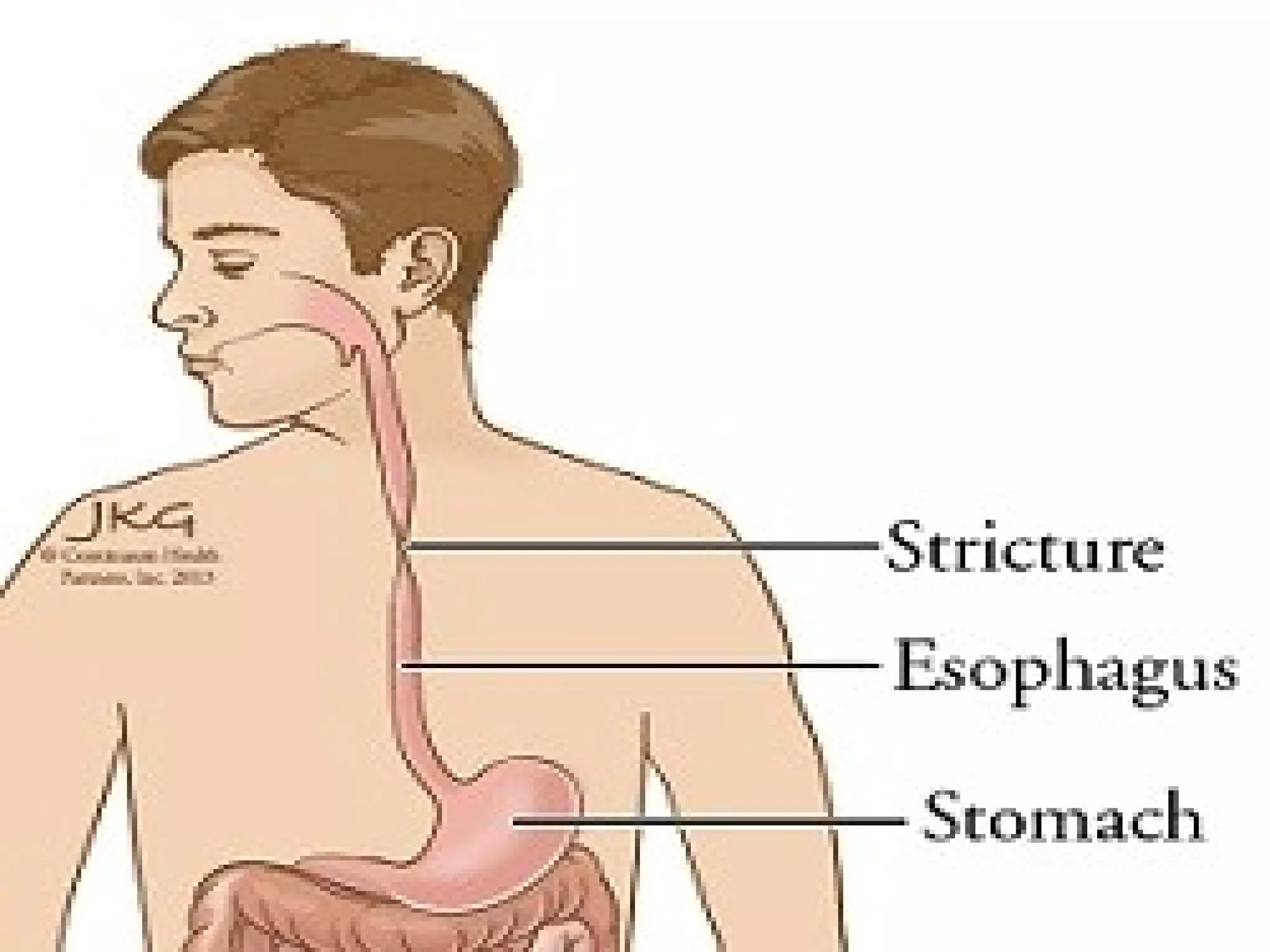 Esophagus stricture | PPT