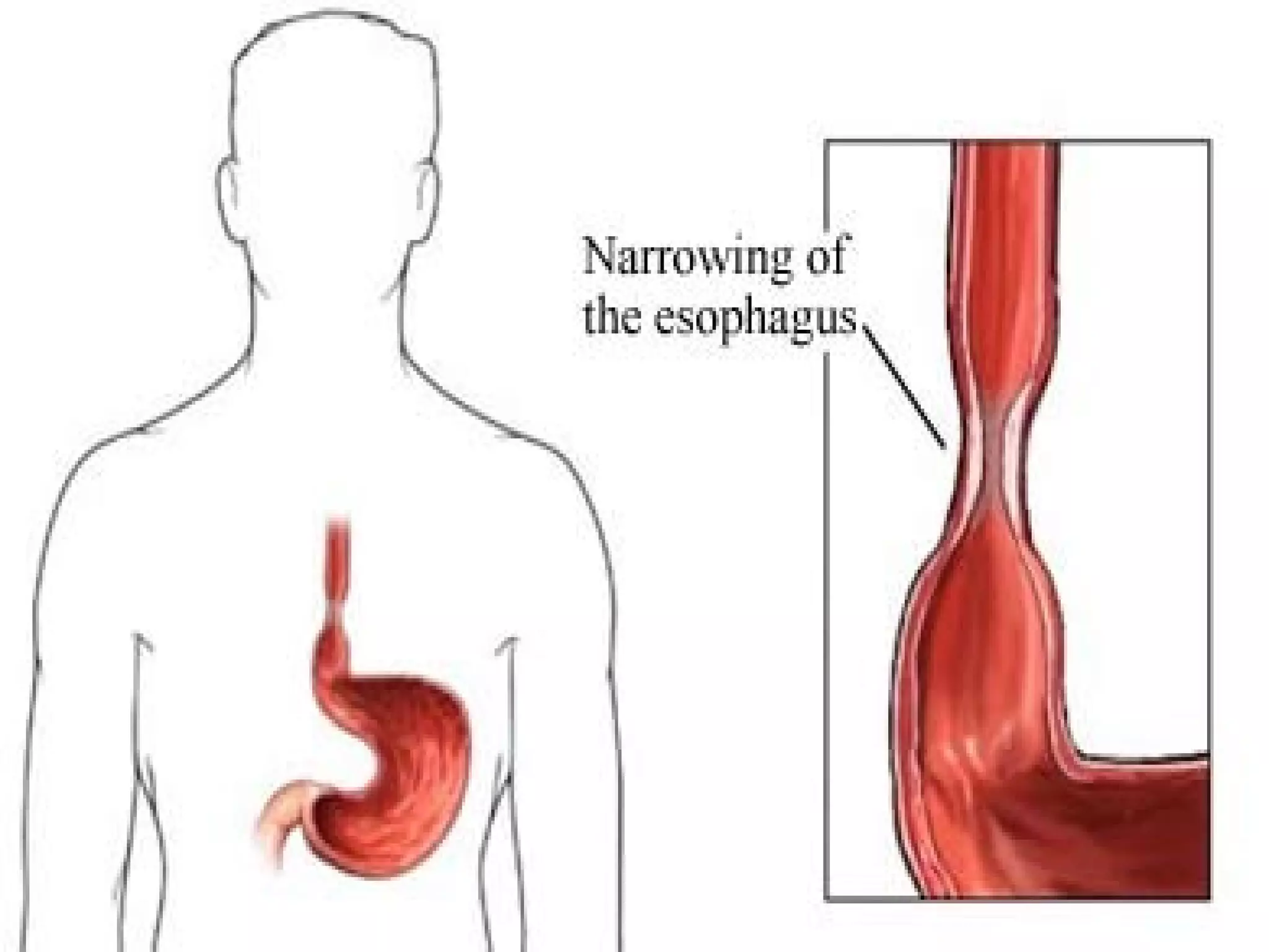 Esophagus stricture | PPT