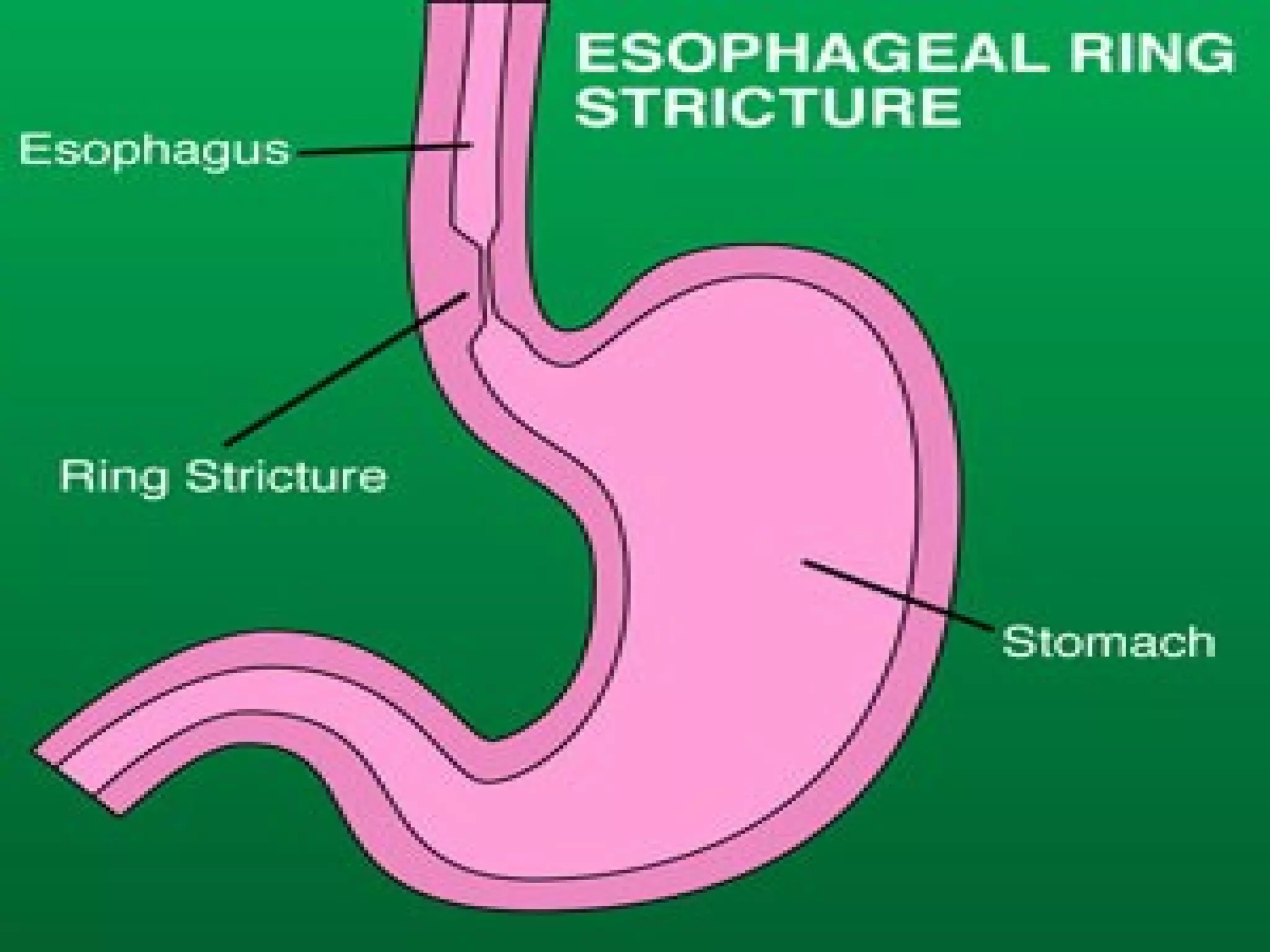 Esophagus stricture | PPT