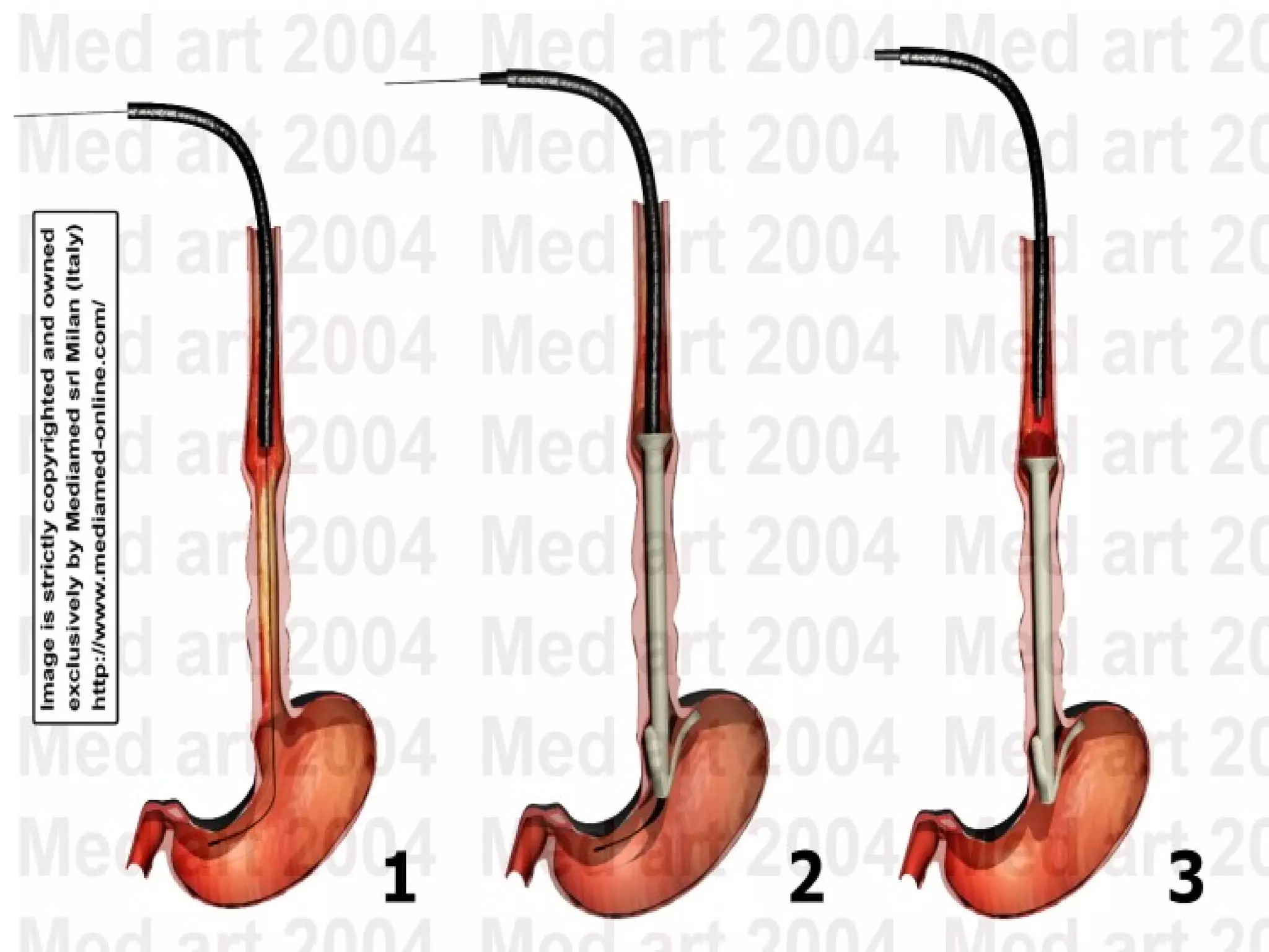 Esophagus stricture | PPT