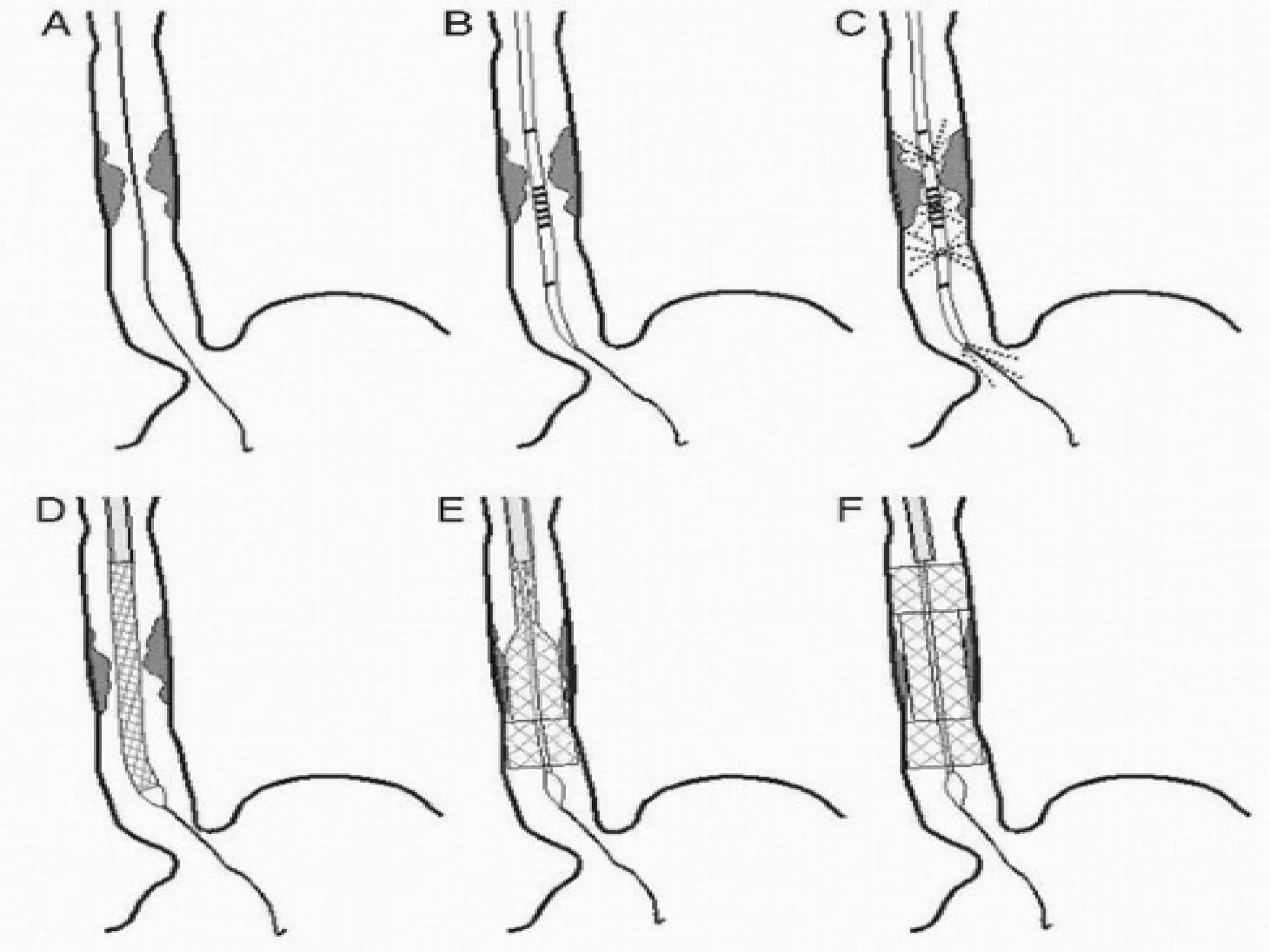 Esophagus stricture | PPT