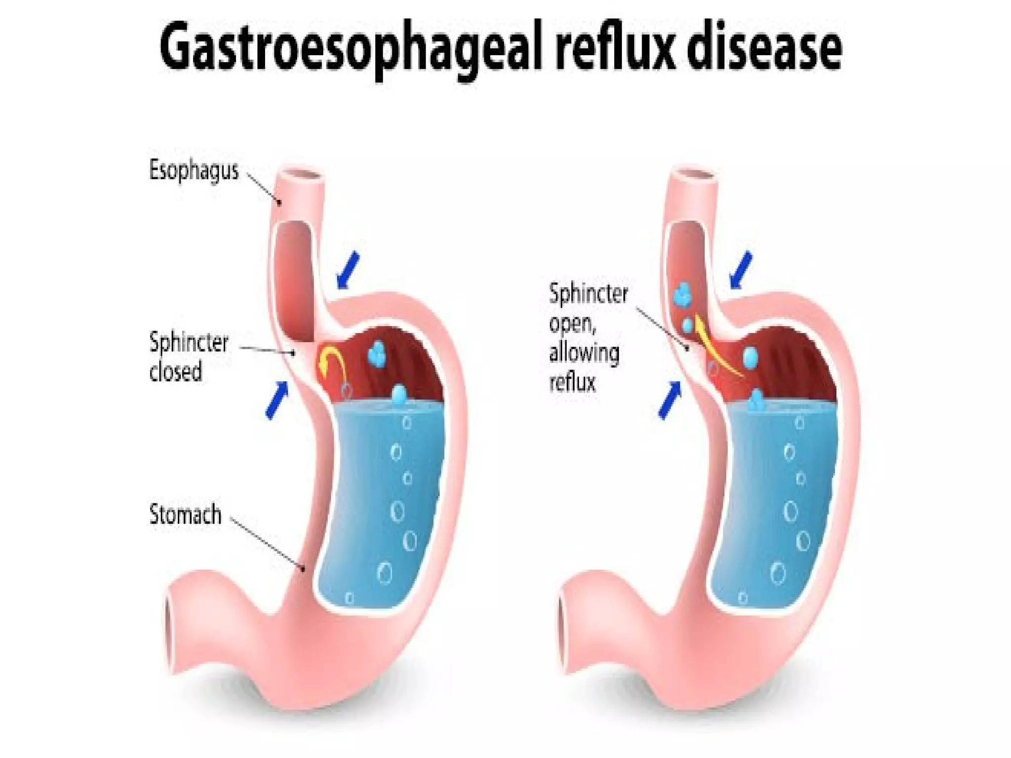 Esophagus stricture | PPT