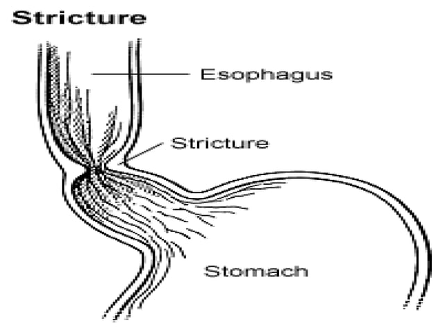 Esophagus stricture | PPT