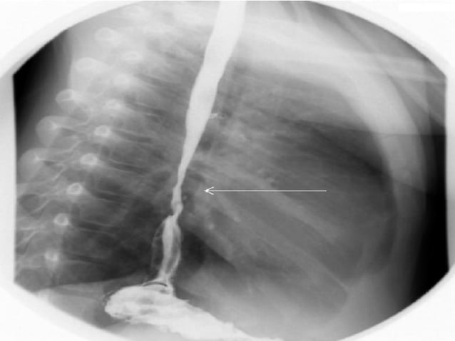 Esophagus stricture | PPT