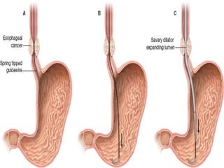 Esophagus stricture | PPT