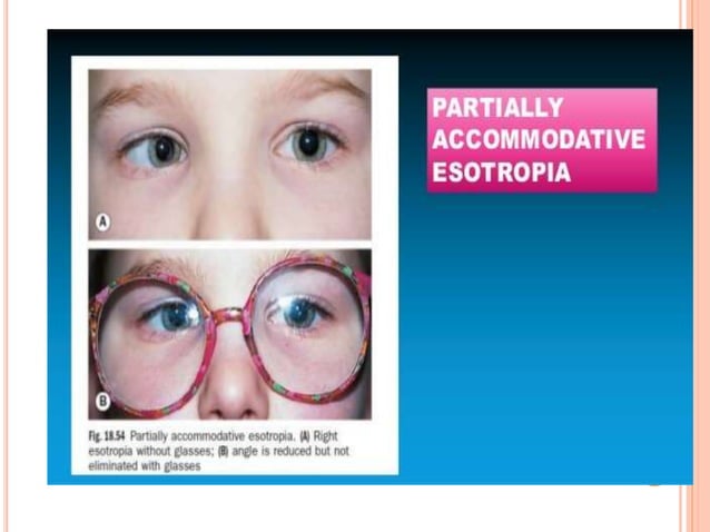 Evaluation of Esotropia in children | PPTX | Eye and Vision Conditions ...
