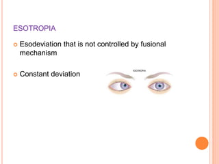 Evaluation of Esotropia in children | PPTX