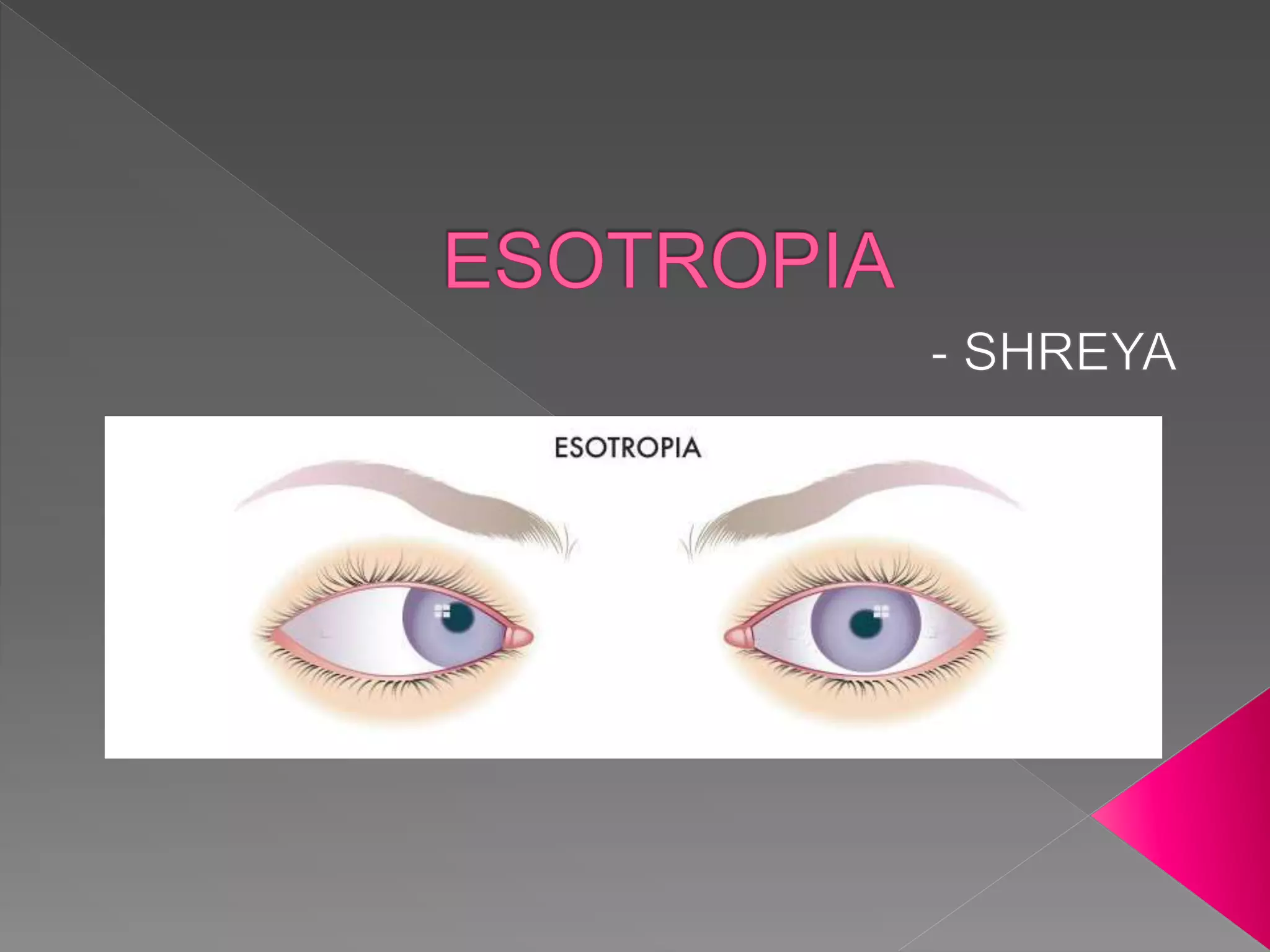 Esotropia | PPTX