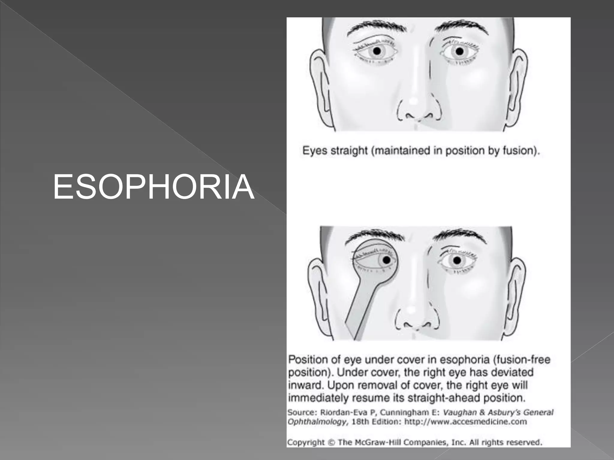 Esotropia | PPTX