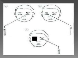 Esotropia | PPTX