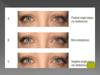 Esotropia | PPTX