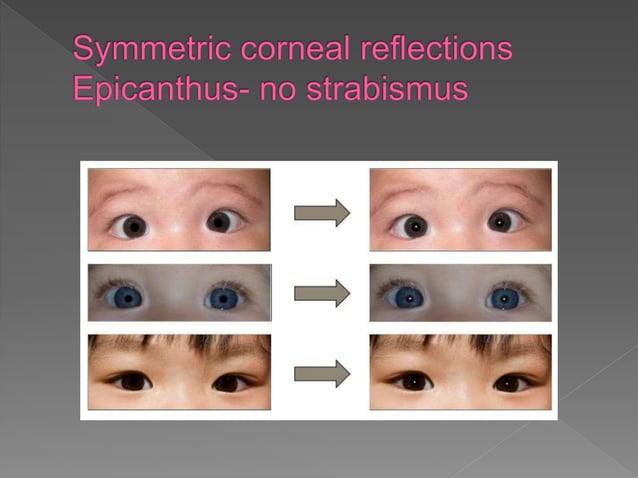 Esotropia | PPTX