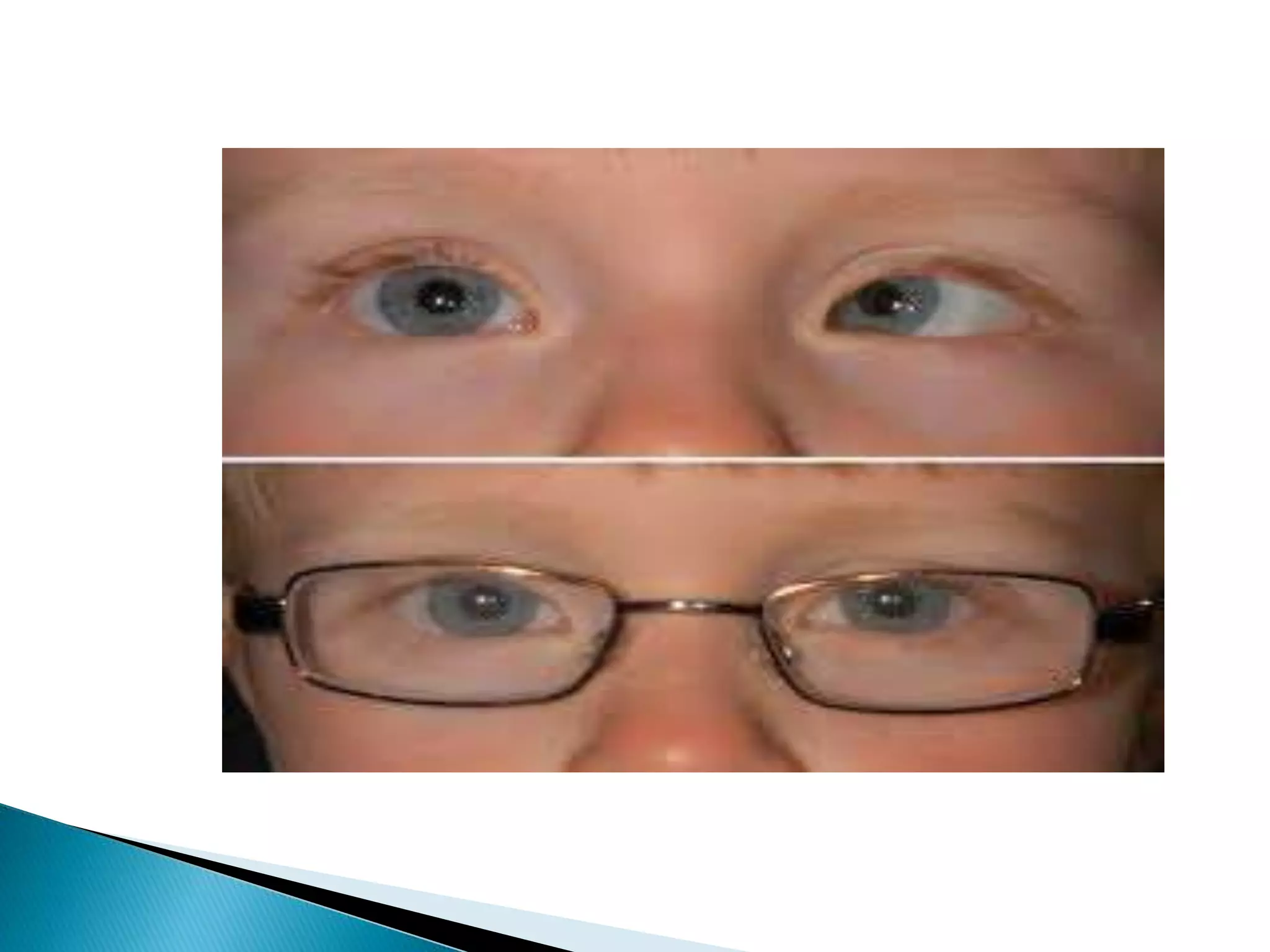 Esotropia , classification , diagnosis and management | PPTX