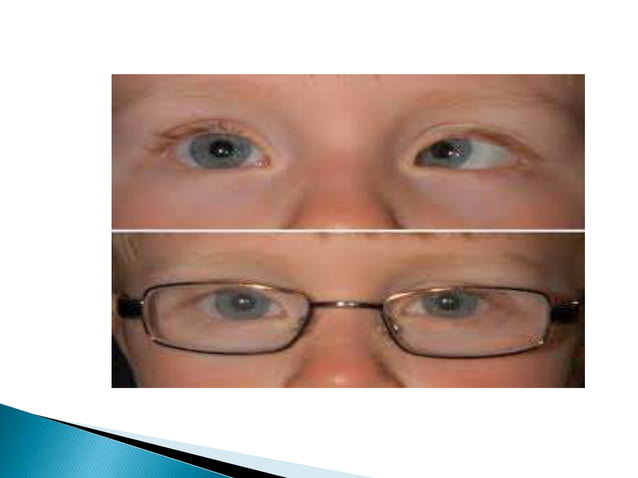 Esotropia , classification , diagnosis and management | PPTX | Eye and ...