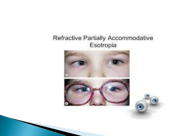 Esotropia , classification , diagnosis and management | PPTX | Eye and ...