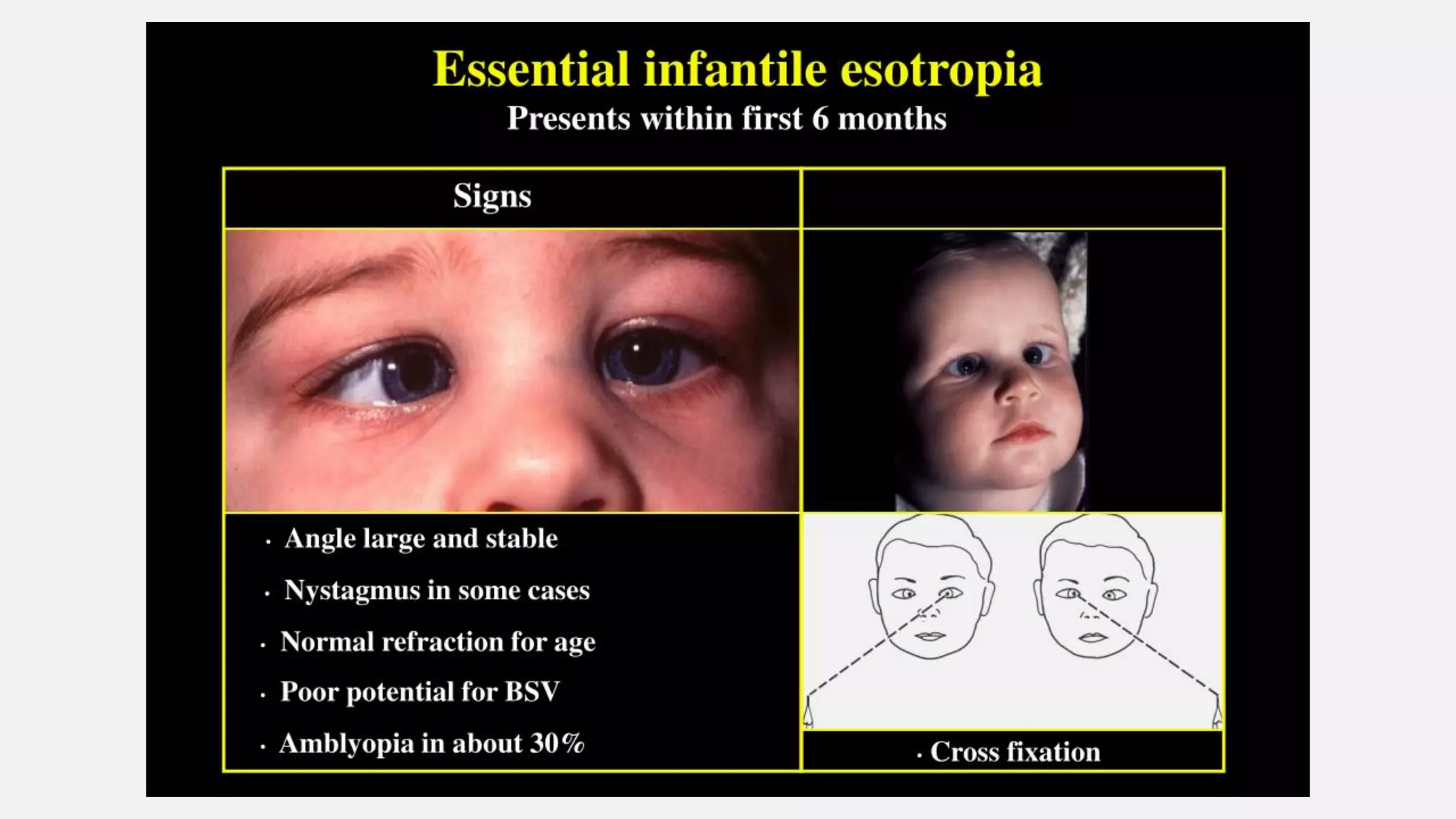 Esotropia | PDF