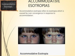 Esotropia by Ashith Tripathi | PPTX